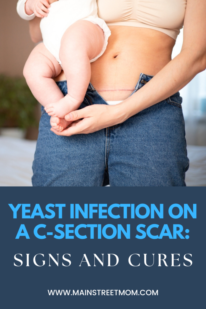 Yeast Infection On A C-Section Scar: Signs And Cures